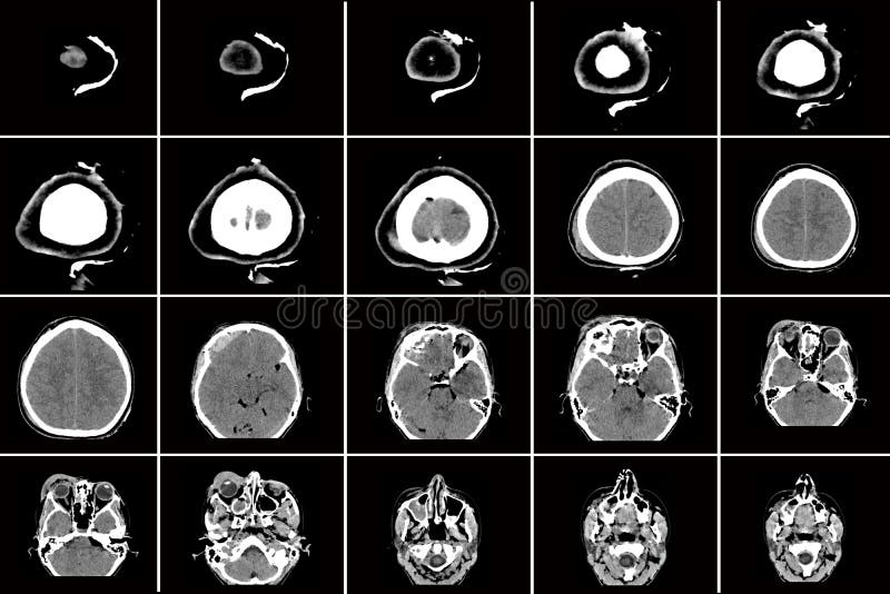 Computed Tomography of the Brain with a Fracture of the Frontal Part of ...