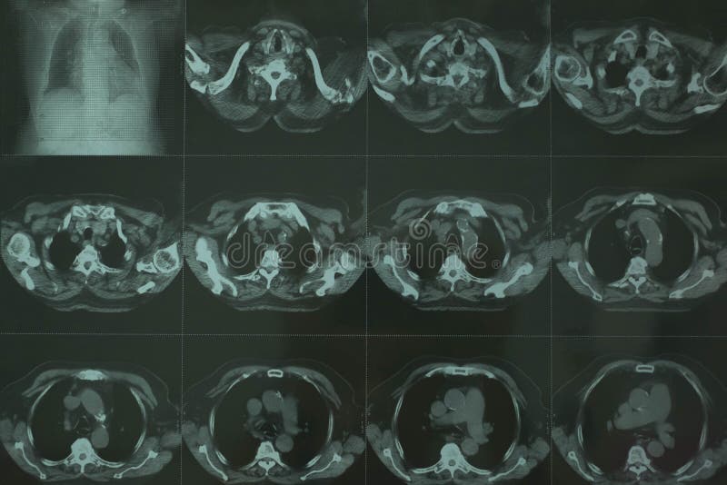 CT scan of chest stock image. Image of lung, computed - 161174625