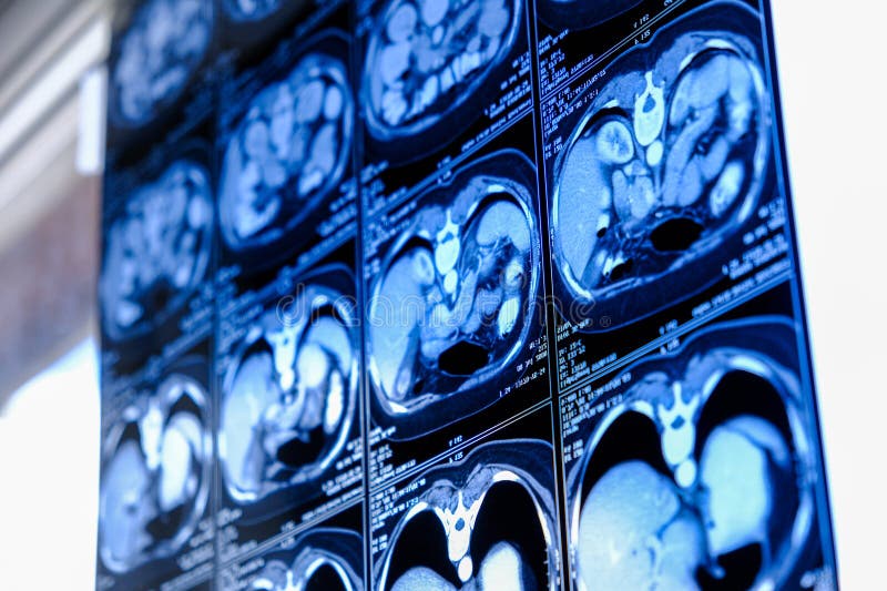 Computed Tomography (CT Scan) of Chest with Abdomen Stock Photo - Image ...