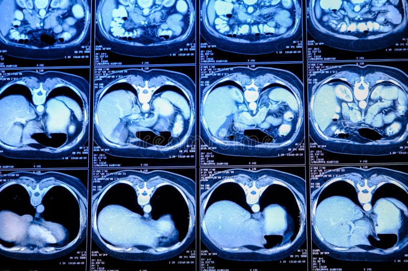 Computed Tomography (CT Scan) of Chest with Abdomen Stock Photo - Image ...
