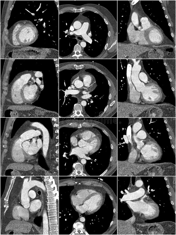 Computed Tomography of the Heart Stock Image - Image of patient, muscle ...