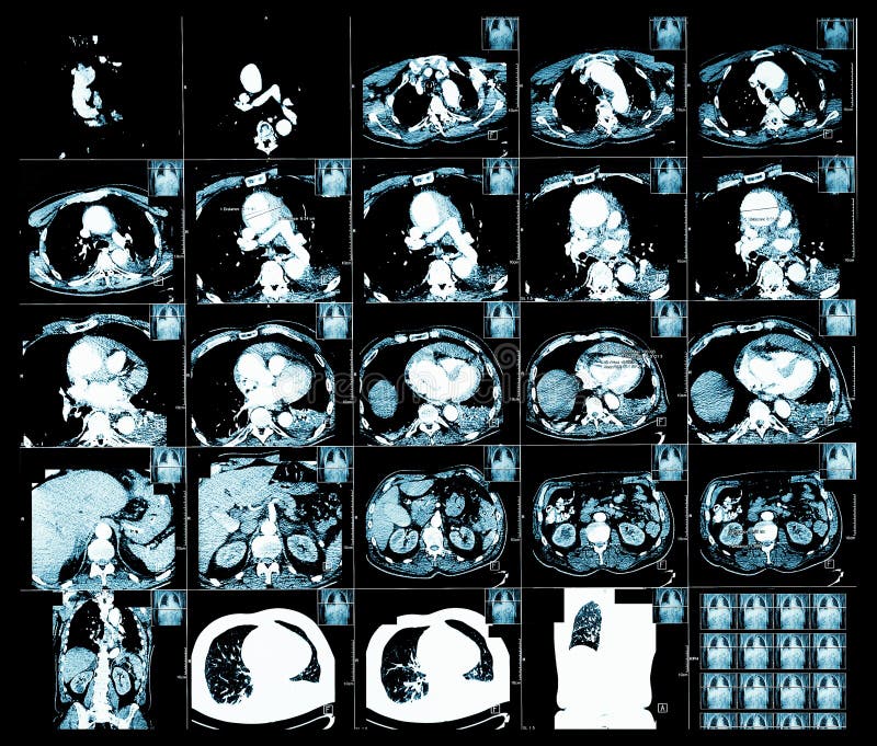 Computed Tomography of the Chest. Medical Background. Stock Photo ...