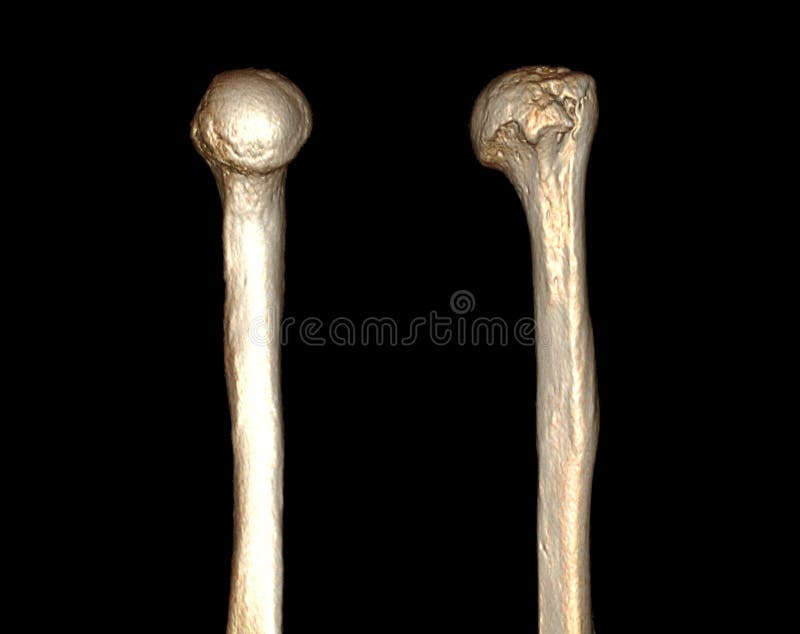 CT scan of shoulder joint stock illustration. Illustration of elbow ...