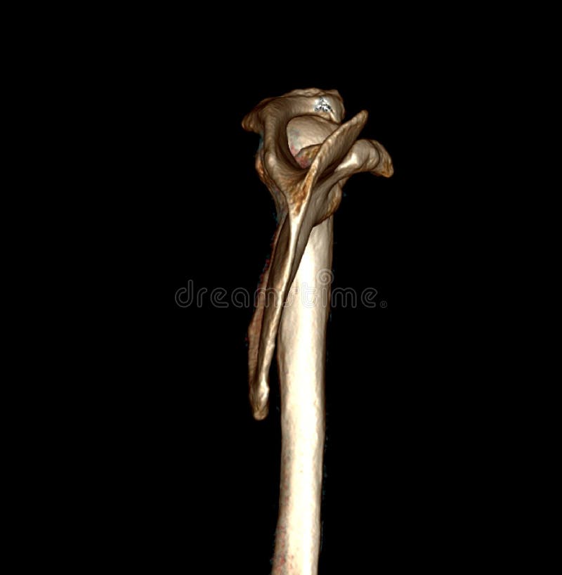 CT Scan of Shoulder Joint and Humerus Bone or Arm Stock Illustration ...