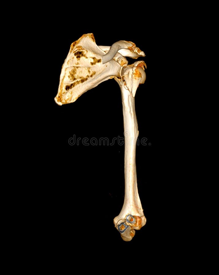 CT Scan of Shoulder Joint and Humerus Bone or Arm Stock Illustration ...