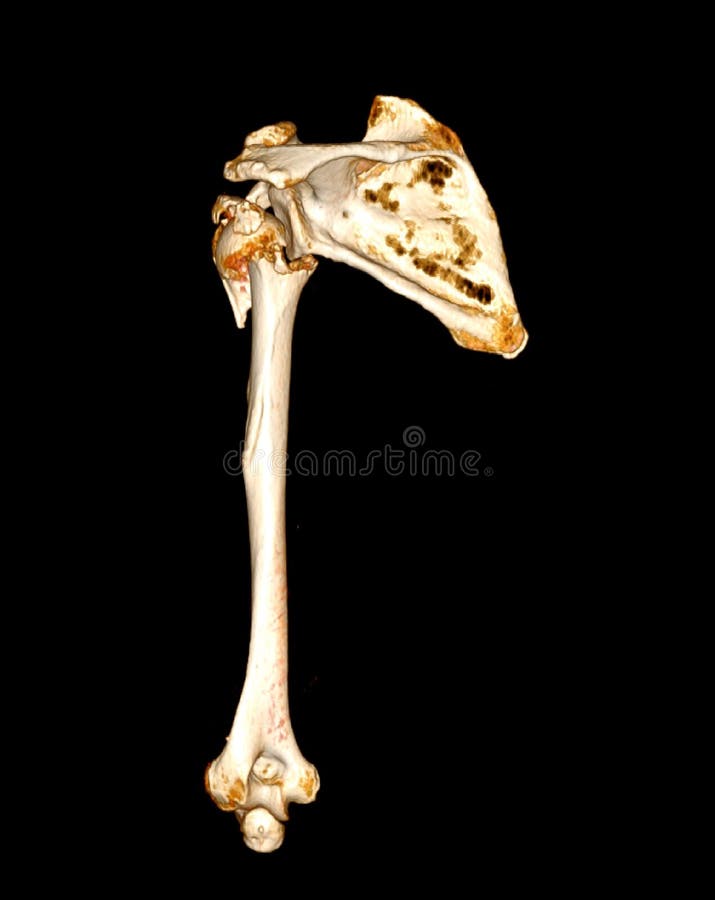 CT Scan of Shoulder Joint and Humerus Bone or Arm Stock Illustration ...