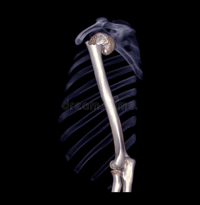 CT Scan of Shoulder Joint and Humerus Bone or Arm Stock Illustration ...