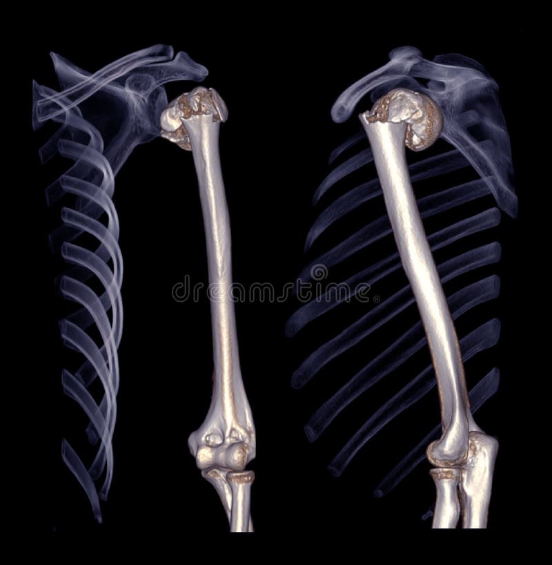 CT Scan of Shoulder Joint and Humerus Bone or Arm Stock Illustration ...