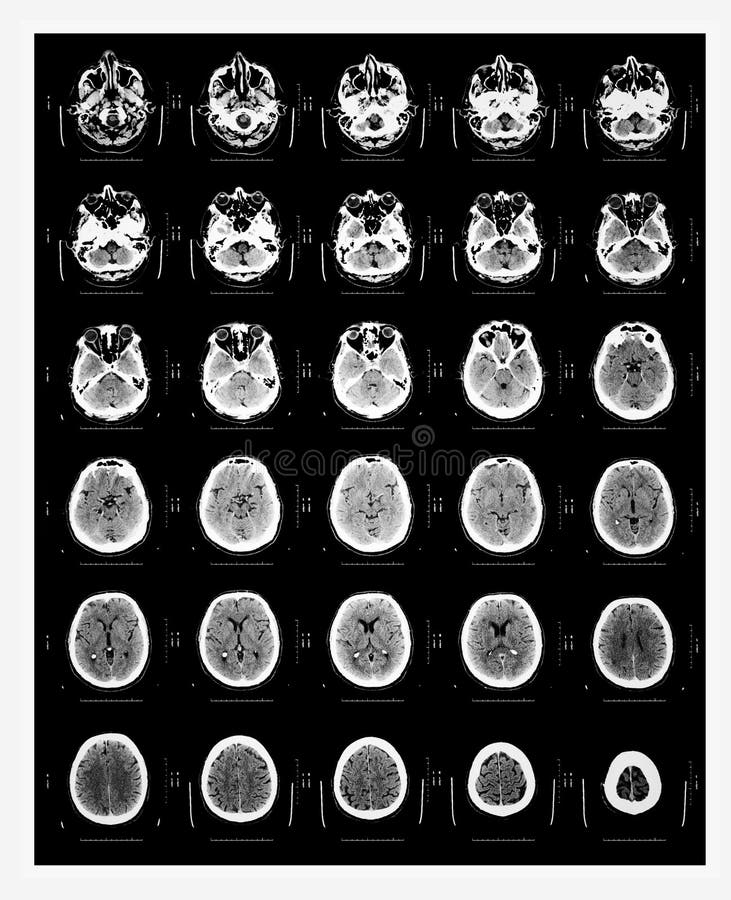 Computer Axial Tomography Scan (CAT) of a Head Stock Photo - Image of ...