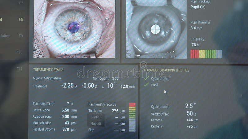 Computer Display with Eye Image during Surgery Stock Footage - Video of ...