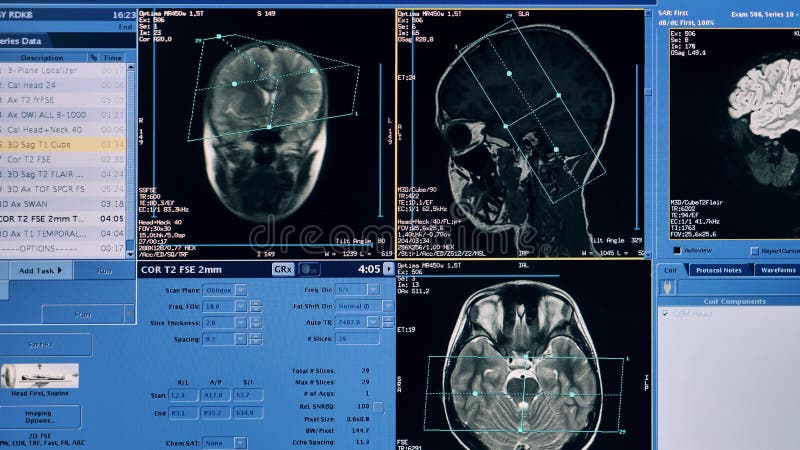 Computer Interface Showing CT Images of a Brain Stock Footage - Video ...