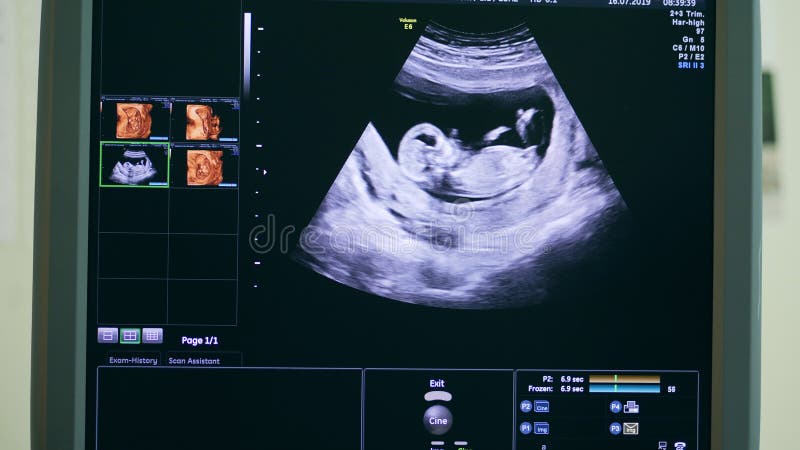 Computer Screen with an Ultrasound Image of a Fetus Stock Video - Video ...