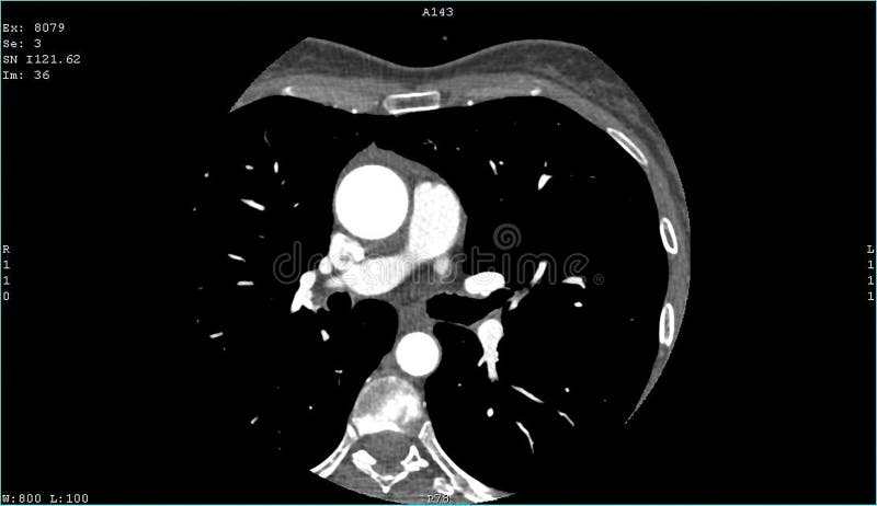 Computerized Tomography CT Coronary Angiogram. Axial Contrast of the ...