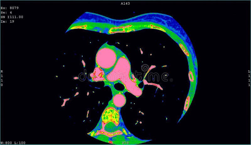 Computerized Tomography CT Coronary Angiogram. Axial Contrast of the ...