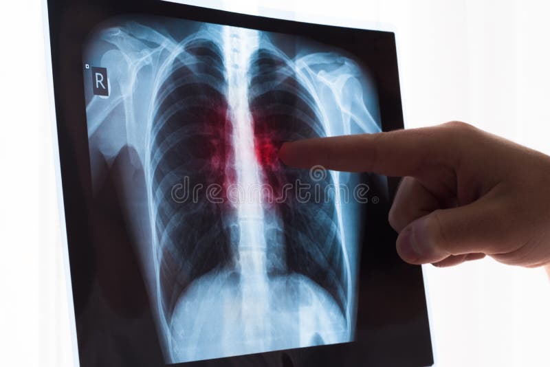 Conceito De Radiografia Pulmonar. Radiologia Médica Examinando No Tórax ... Conceito De Radiografia Pulmonar. Radiologia Médica Examinando No Tórax ...