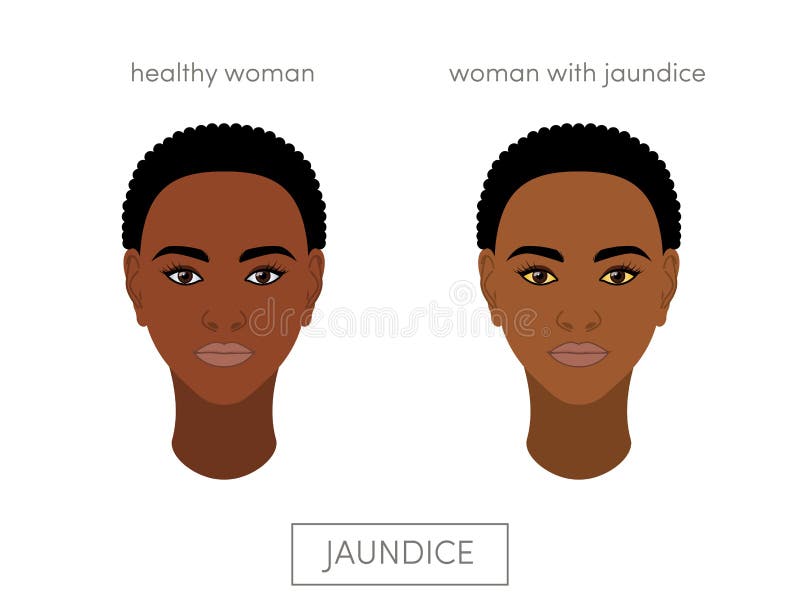 Concept d'ictère illustration stock. Illustration du pigmentation ...