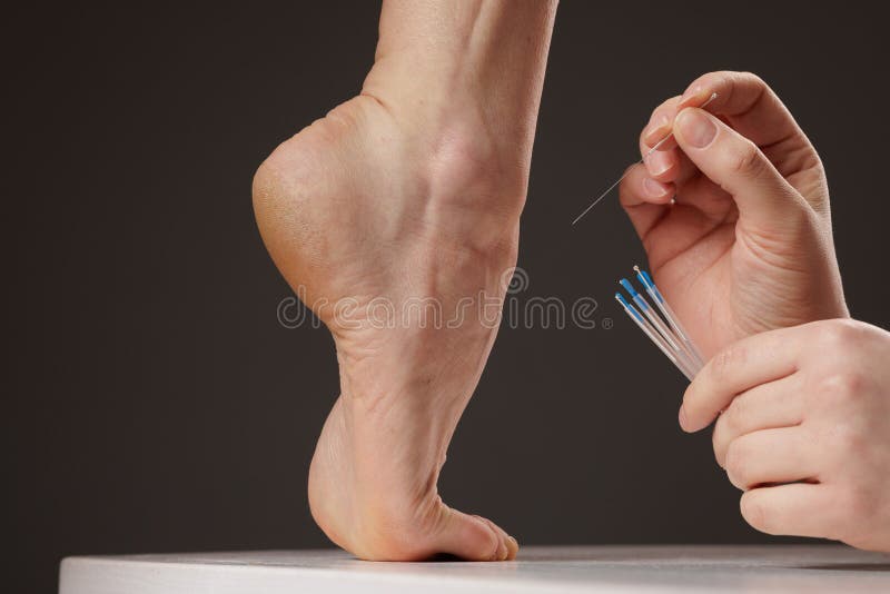 Concept Dry Needling Method, Acupuncture Therapy on the Foot, Close-up ...