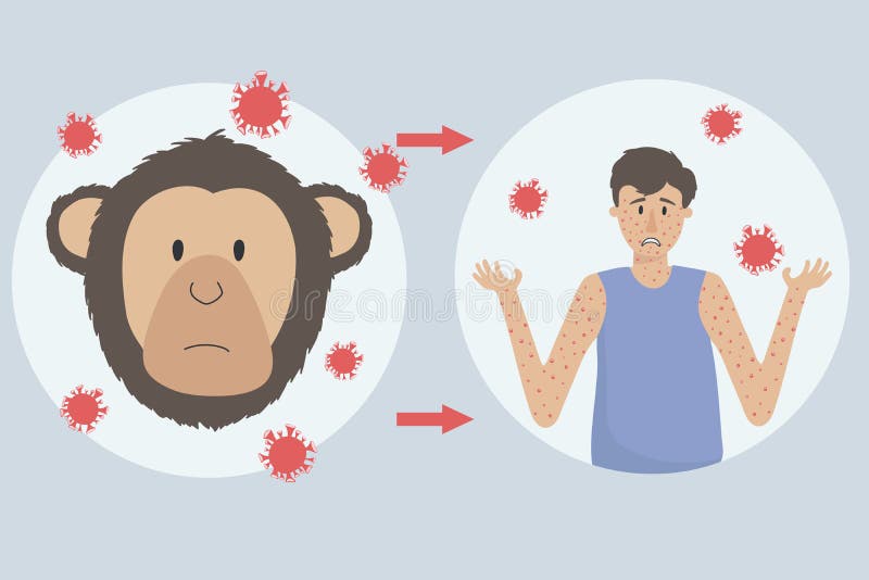 Monkeypox Virus Shows the Route of Infection from a Monkey and the ...