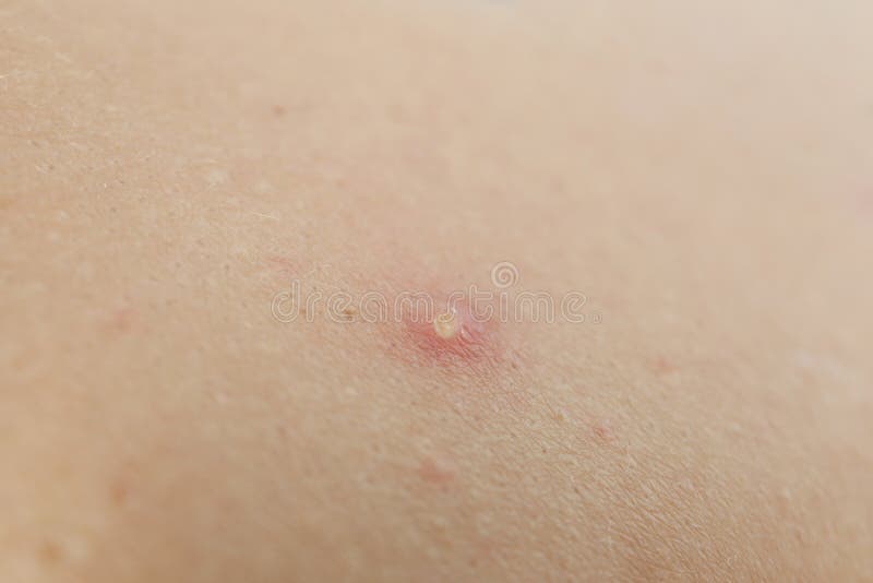 Concept of Skin Problems, Acne, Close Up Stock Photo - Image of ...