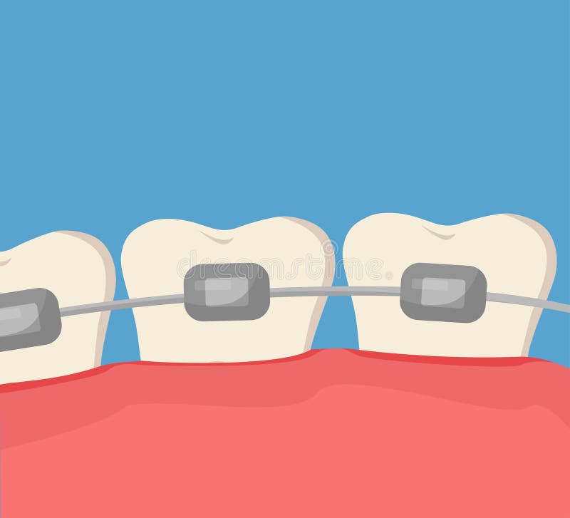 The Concept of Teeth Alignment with Braces. Simple Teeth in a Row ...