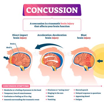 Concussion Vector Illustration. Labeled Educational Post Head Trauma ...