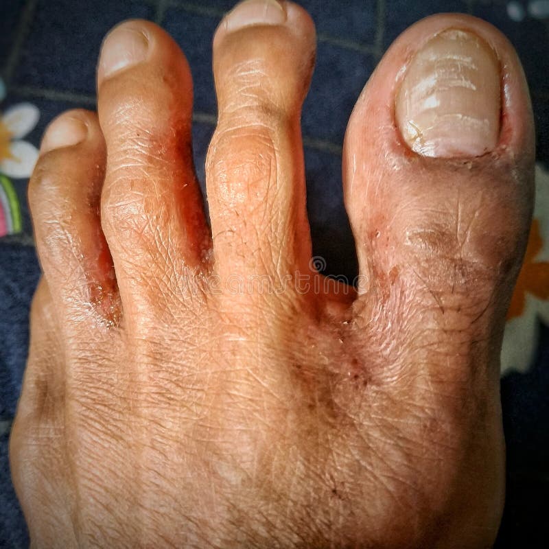 Condition of Feet Affected by Water Fleas Stock Photo - Image of water ...