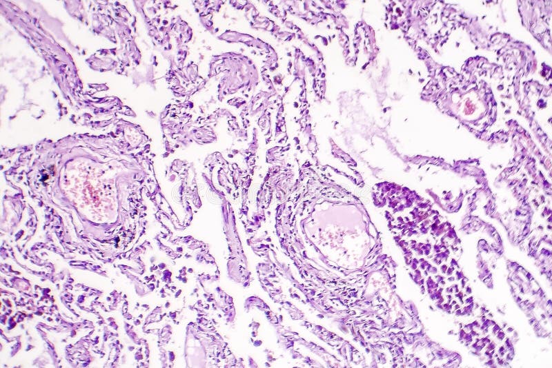 Congestión Pulmonar Crónica Y Edema Foto de archivo - Imagen de edema ...