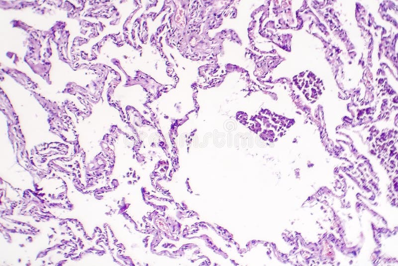 Congestión Pulmonar Crónica Y Edema Foto de archivo - Imagen de edema ...