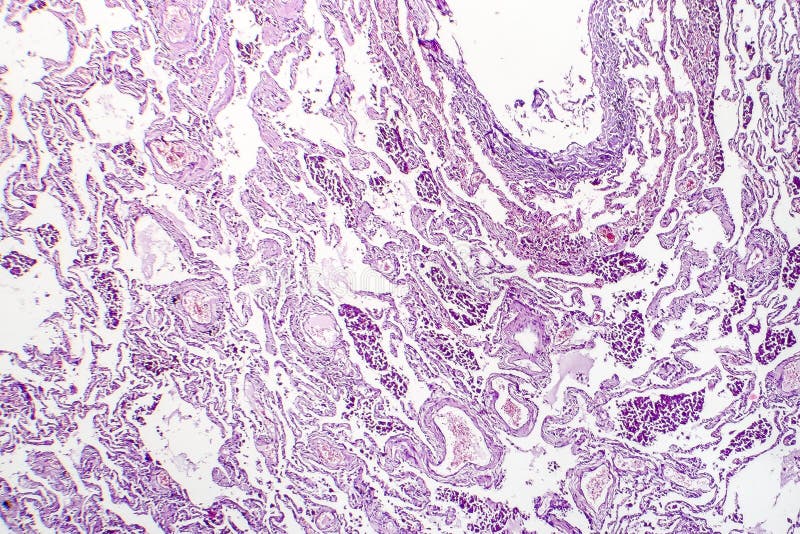 Congestión Pulmonar Crónica Y Edema Foto de archivo - Imagen de mancha ...