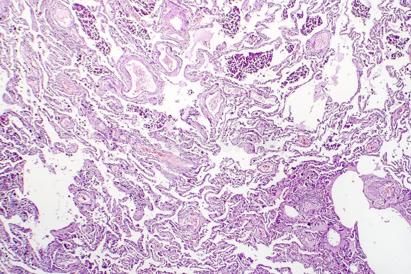 Congestión Pulmonar Crónica Y Edema Imagen de archivo - Imagen de edema ...