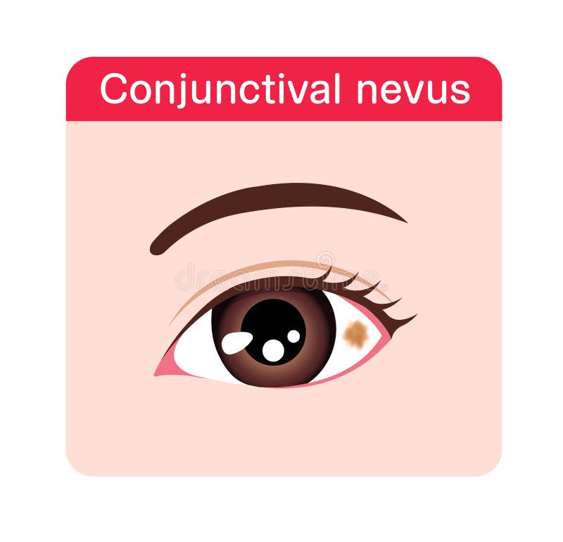 Conjunctival Nevus Vector Illustration Stock Vector - Illustration of ...