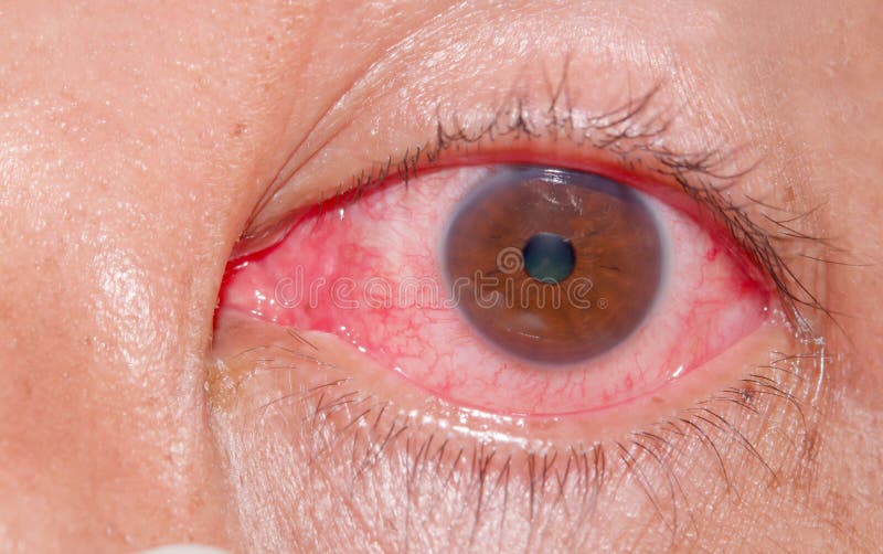Conjunctivitis, Blood and Stool, Stock Photo - Image of eyeball ...