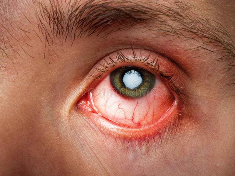 Conjunctivitis Conjunctivale Ontsteking Rode Ogen Infectie En ...
