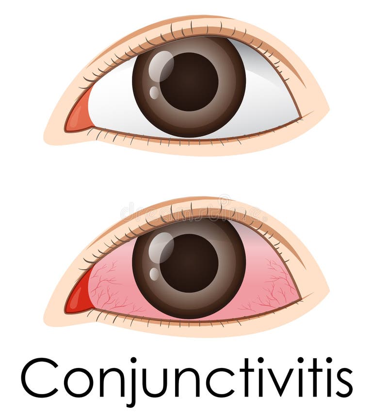 Conjunctivitis stock vector. Illustration of inflammation - 24711945