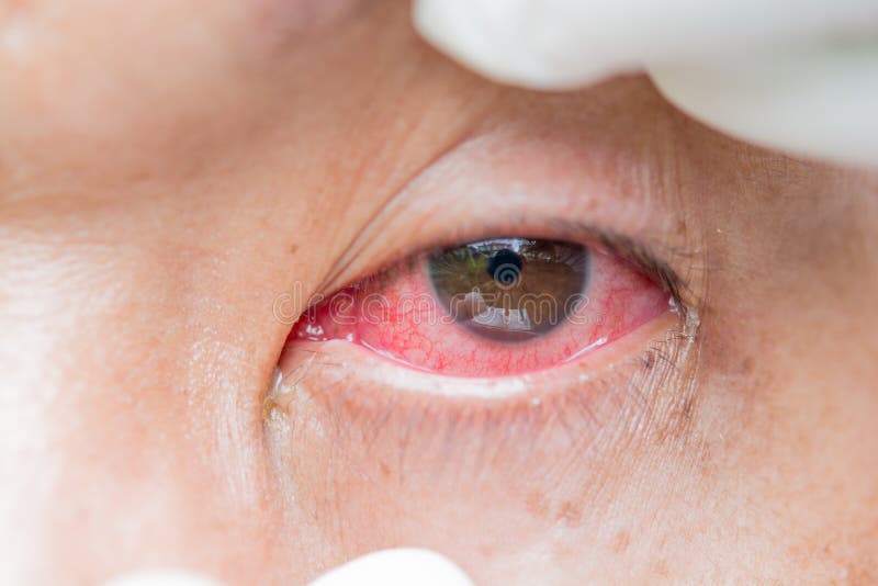 Chronic conjunctivitis eye stock photo. Image of healthy - 31267484