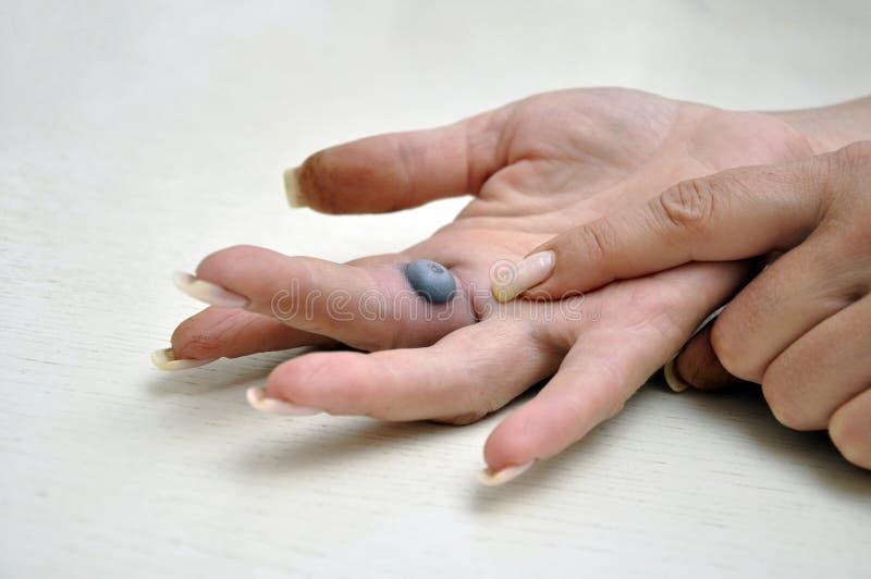 Consequence of Removing Warts on the Hand with Liquid Nitrogen. Burn ...