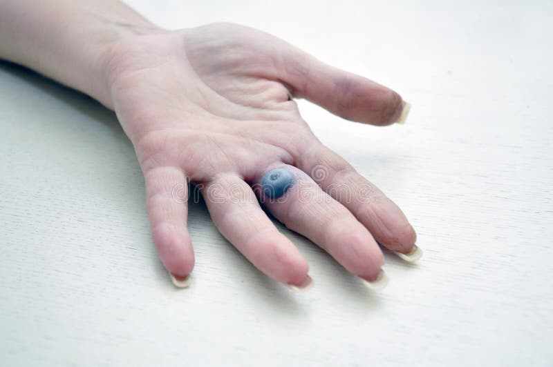 Consequence of Removing Warts on the Hand with Liquid Nitrogen. Burn ...