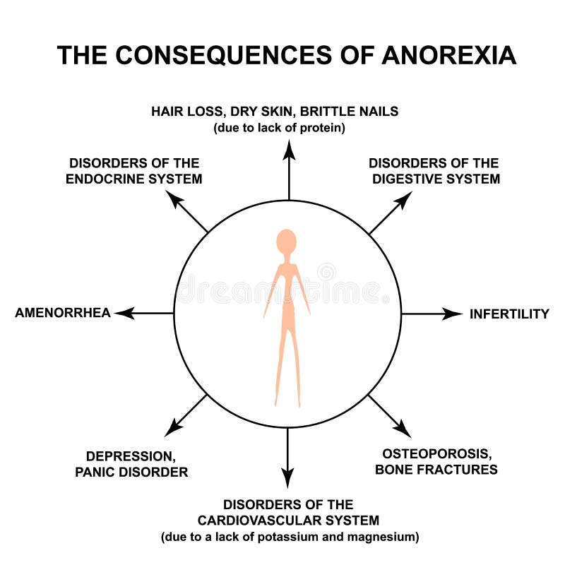 Anorexia Symptoms. Slim Physique With Anorexia. Infographics. Vector ...