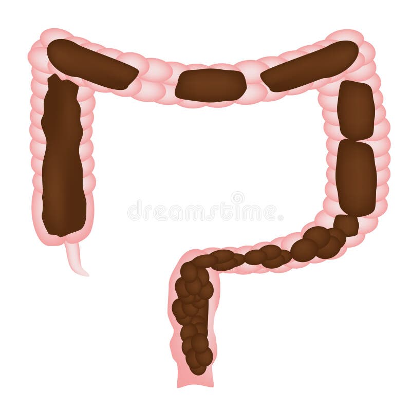 Constipation. Feces in Colon. Infographics. Vector Illustration on ...