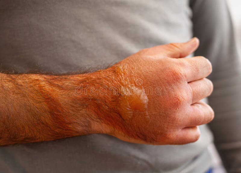 Construction Worker Showing Second Degree Burn on Arm Stock Photo ...