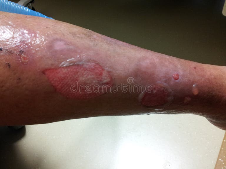 Contact Dermatitis with Ruptured Vesicles and Bullae Stock Image ...