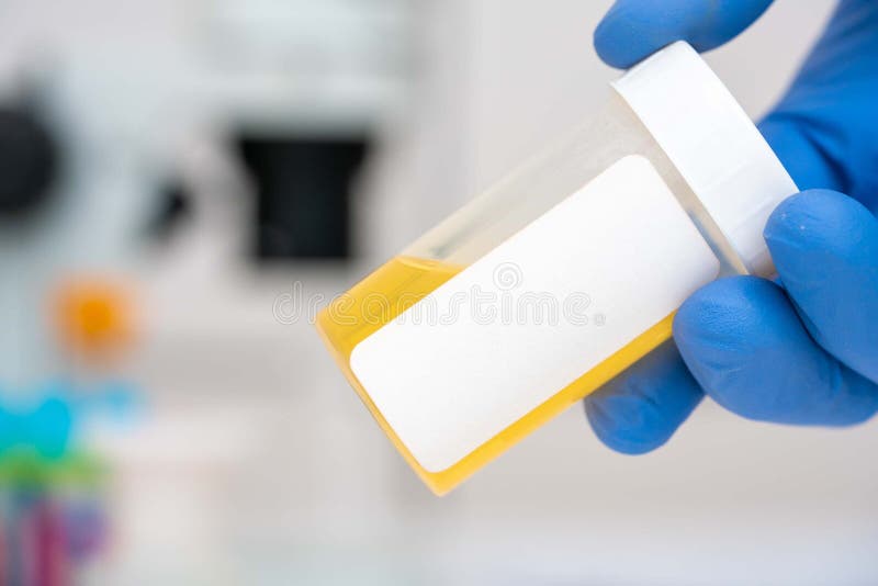 Container with a Urine Sample for Microbiological Laboratory Analysis ...