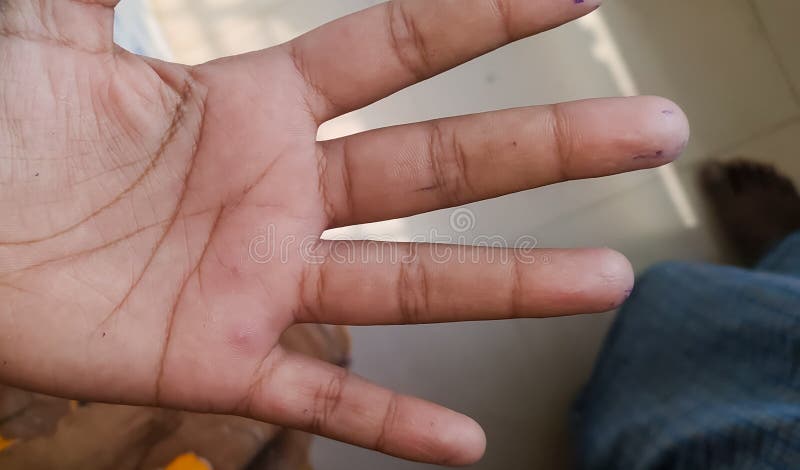 Contamination Diseases - Chicken Pox - Image of Chicken Pox Symptoms on ...