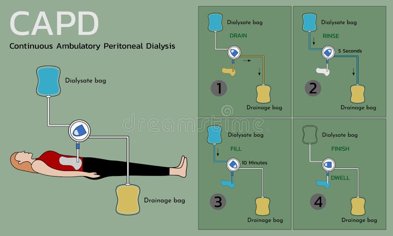 Continuous Ambulatory Peritoneal Dialysis Stock Illustrations – 9 ...