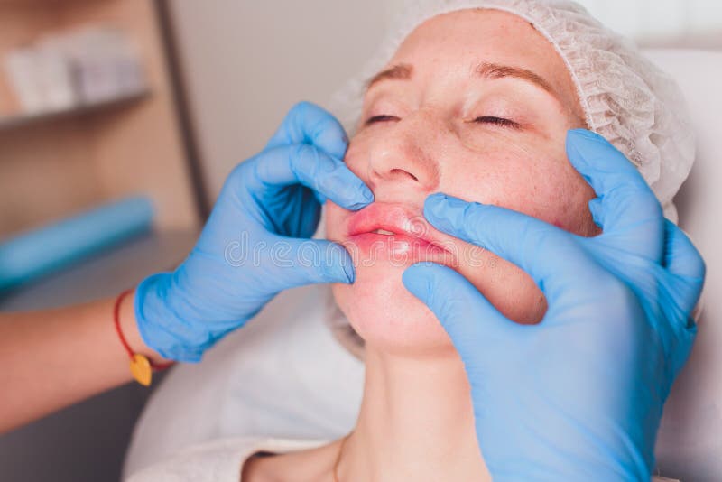 Contour Plastic: Lip Massage after Injection of Filler. Stock Photo ...
