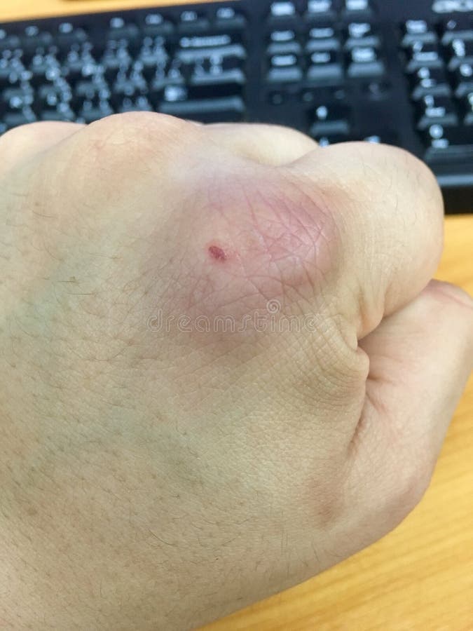 Contusión a mano foto de archivo. Imagen de violencia - 47983996