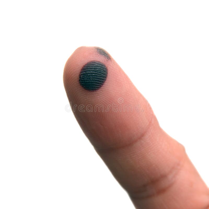 Contusión en el dedo gordo foto de archivo. Imagen de cuidado - 111543688