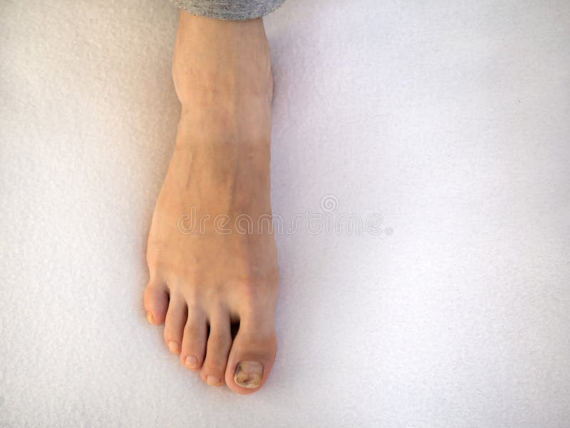 Contusión En El Dedo Del Pie Del Pie Problemas Del Pie Imagen de ...