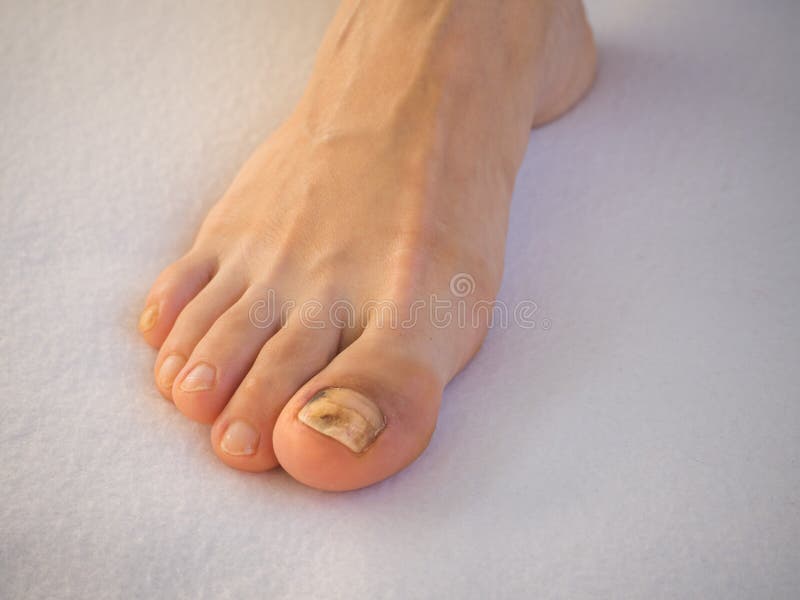 Contusión En El Dedo Del Pie Del Pie Problemas Del Pie Imagen de ...