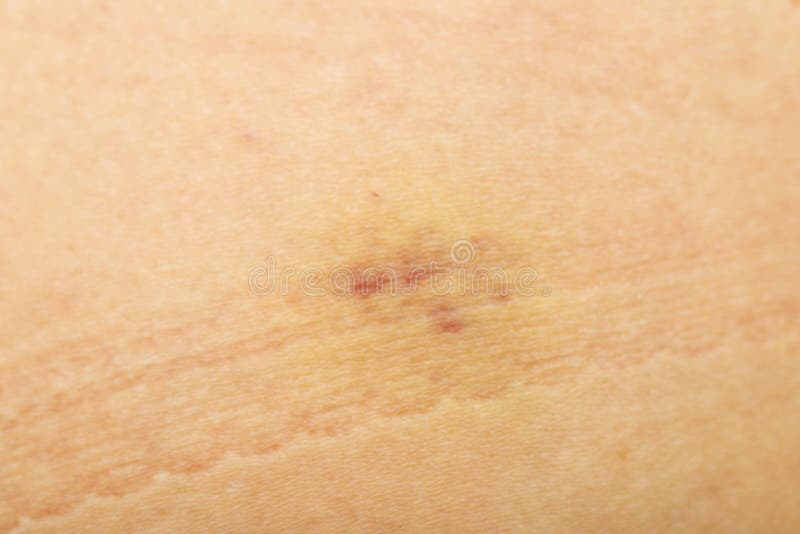Contusion Sur Le Bras De L'homme Contusions D'injection Macro ...